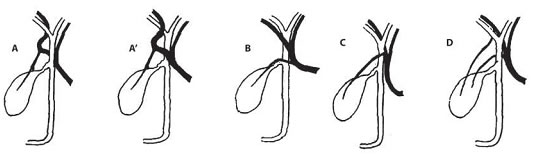 Figura 34.14. Variações anatômicas vasculares do pedículo hepático. A e ...