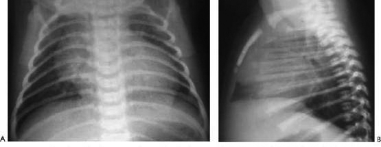 Figura 1-3. A. Radiografia de tórax em AP simulando doença pulmonar ou ...